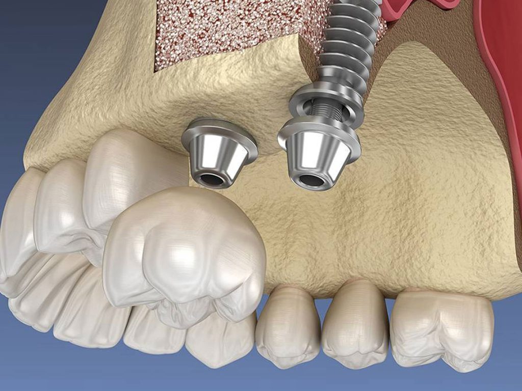 What is Sinus Lift - Prof. Dr. Ömer Kutay